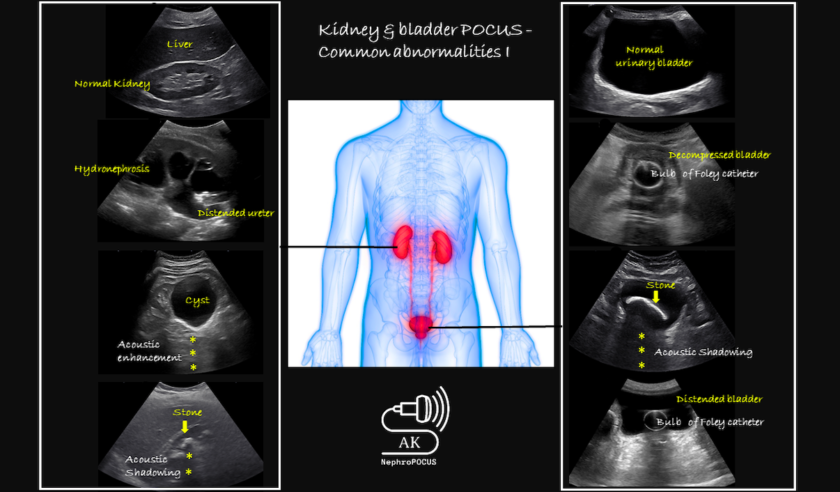POCUS Gallery - Renal Fellow Network