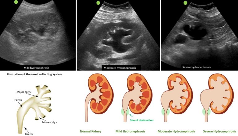 The Ultrasound Mimics of Hydronephrosis - Renal Fellow Network