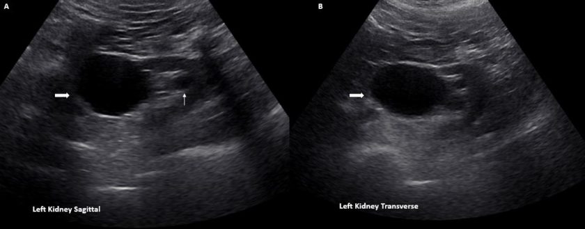 The Ultrasound Mimics of Hydronephrosis - Renal Fellow Network