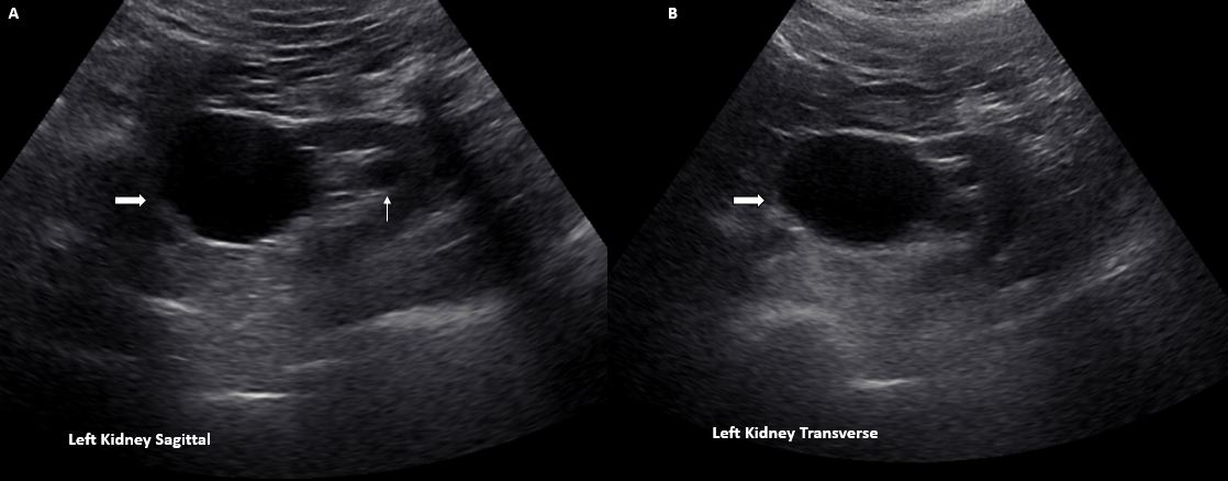 The Ultrasound Mimics of Hydronephrosis - Renal Fellow Network