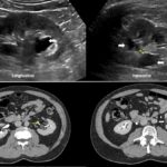 The Ultrasound Mimics of Hydronephrosis - Renal Fellow Network