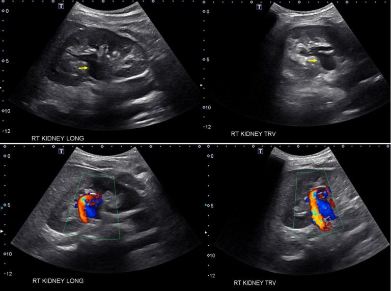 The Ultrasound Mimics of Hydronephrosis - Renal Fellow Network