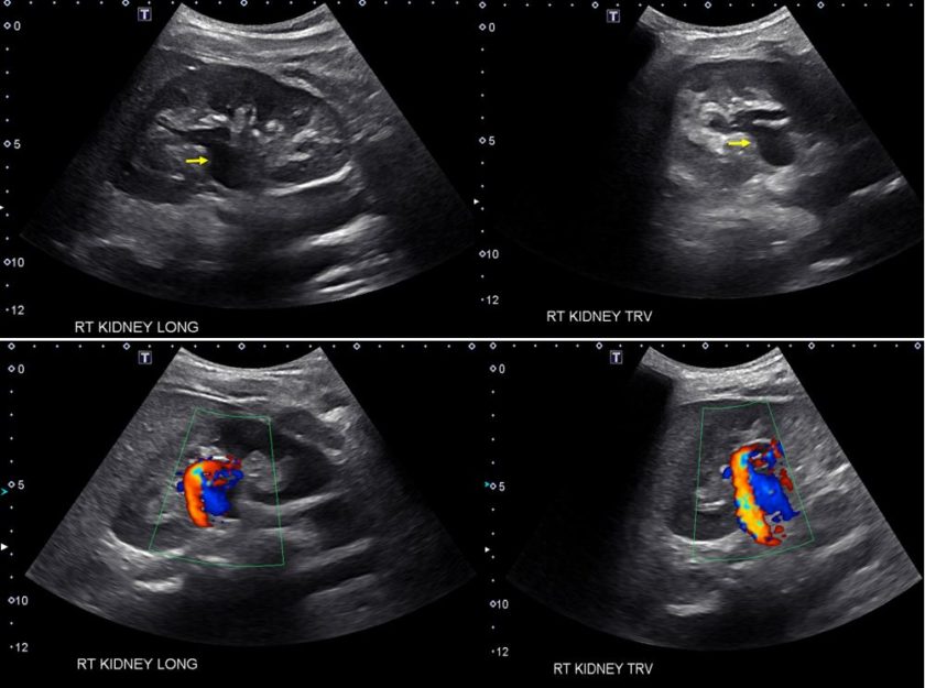 The Ultrasound Mimics of Hydronephrosis - Renal Fellow Network