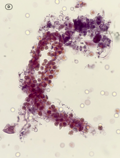 Urine Sediment of the Month: White Blood Cells, “Glitter Cells”, and ...