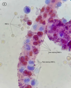 Urine Sediment of the Month: White Blood Cells, “Glitter Cells”, and ...
