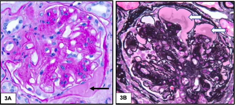 Kidney Biopsy of the Month: Diabetic Nephropathy - Renal Fellow Network