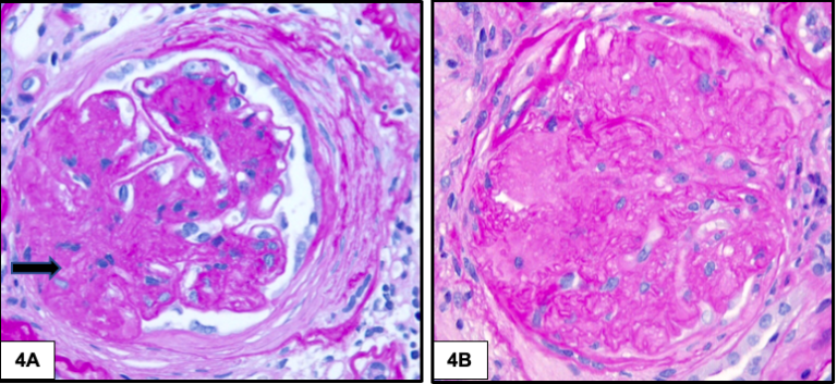 Kidney Biopsy of the Month: Diabetic Nephropathy - Renal Fellow Network