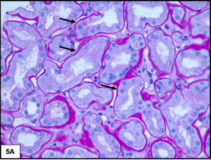 Kidney Biopsy of the Month: Diabetic Nephropathy - Renal Fellow Network