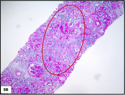 Kidney Biopsy of the Month: Diabetic Nephropathy - Renal Fellow Network