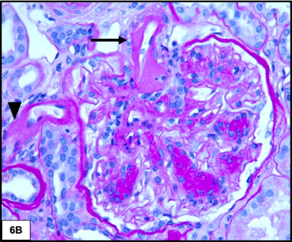 Kidney Biopsy of the Month: Diabetic Nephropathy - Renal Fellow Network