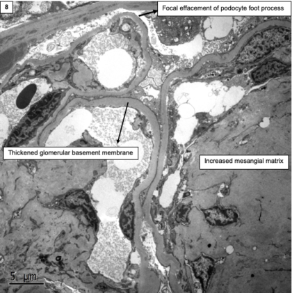 Kidney Biopsy of the Month: Diabetic Nephropathy - Renal Fellow Network