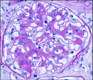 Urine Sediment of the Month: White Blood Cells, “Glitter Cells”, and ...