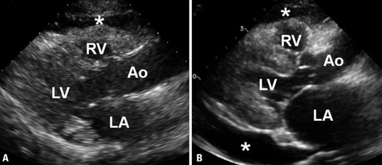 Introduction to Focused Cardiac Ultrasound: The Parasternal Long Axis ...