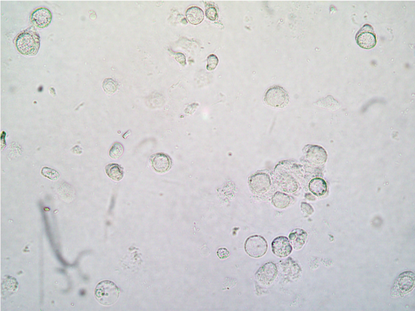 Cells In Urine Sediment Chart Urine Sediment Of The Month: Fat Oval