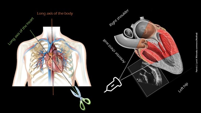 Introduction to Focused Cardiac Ultrasound: The Parasternal Long Axis ...