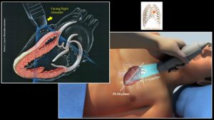 Introduction to Focused Cardiac Ultrasound: The Parasternal Long Axis ...