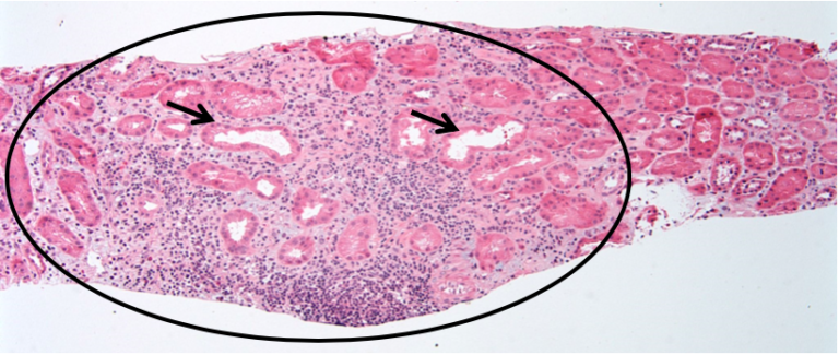 Kidney Biopsy of the Month – Acute Interstitial Nephritis - Renal ...