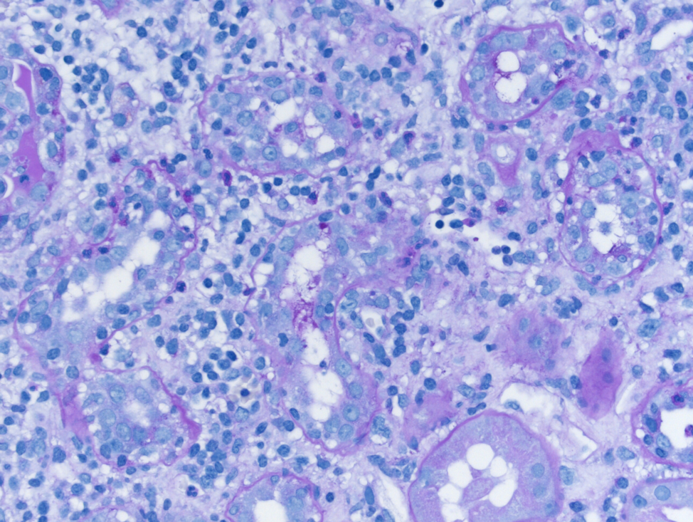 Kidney Biopsy of the Month – Acute Interstitial Nephritis - Renal ...