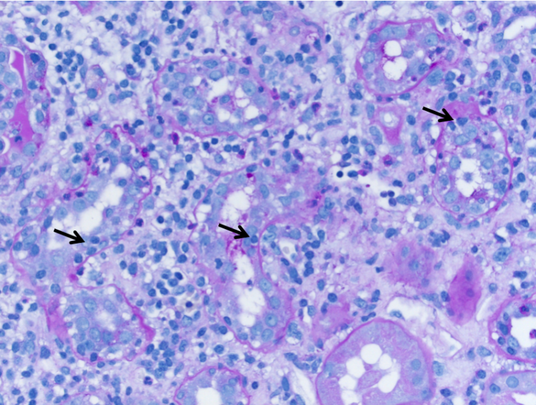Kidney Biopsy of the Month – Acute Interstitial Nephritis - Renal ...