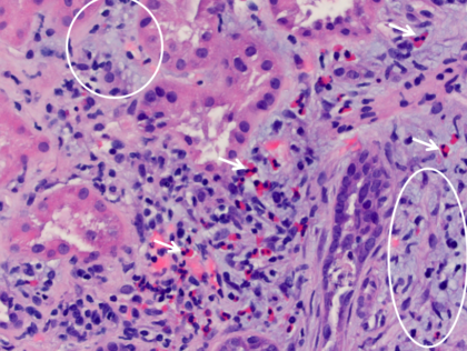 Kidney Biopsy of the Month – Acute Interstitial Nephritis - Renal ...