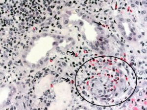 Kidney Biopsy of the Month – Acute Interstitial Nephritis - Renal ...