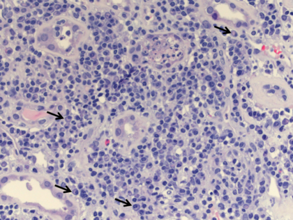 Kidney Biopsy of the Month – Acute Interstitial Nephritis - Renal ...