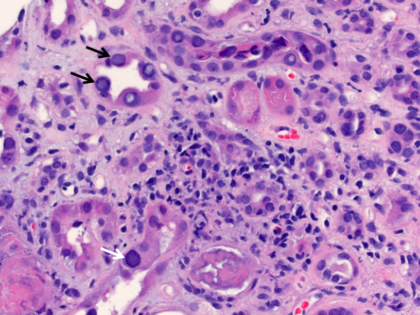 Kidney Biopsy of the Month – Acute Interstitial Nephritis - Renal ...