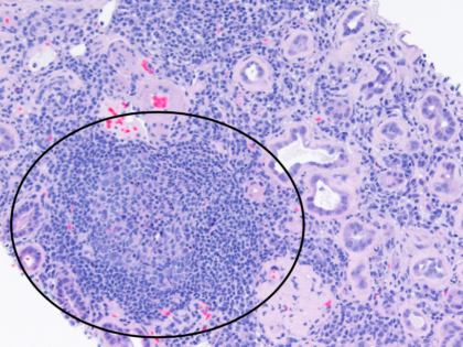 Kidney Biopsy of the Month – Acute Interstitial Nephritis - Renal ...