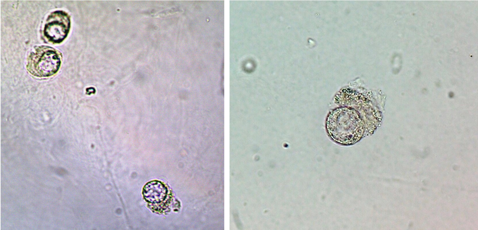 Kidney Biopsy of the Month – Acute Interstitial Nephritis - Renal ...