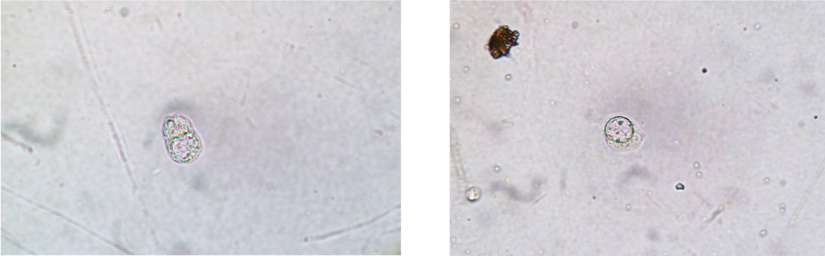 Urine Sediment of the Month: Don't be Fooled by Decoy Cells...A Clue to BK Polyomavirus ...
