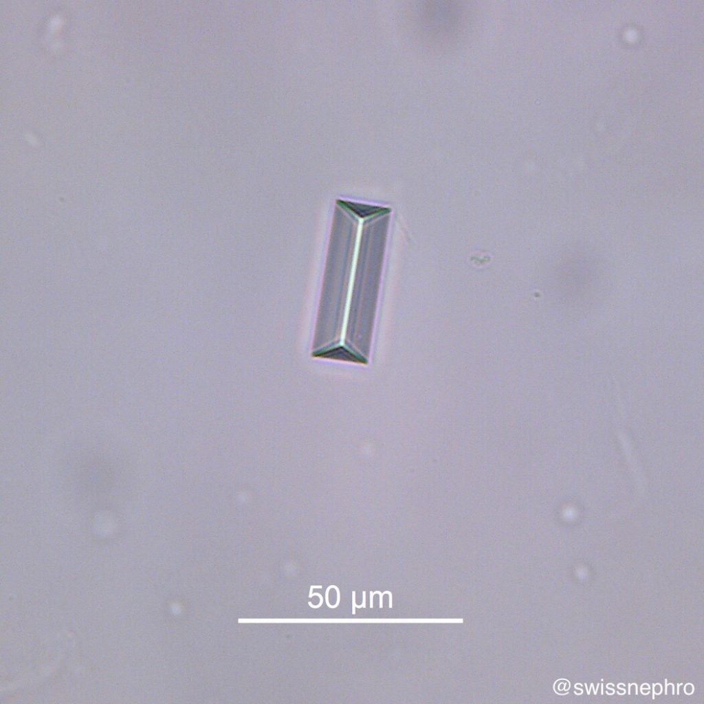 Urine Sediment of the Month: Common Crystals! - Renal Fellow Network
