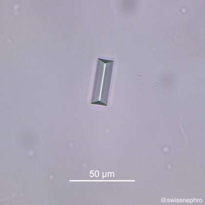 Urine Sediment of the Month: Common Crystals! - Renal Fellow Network
