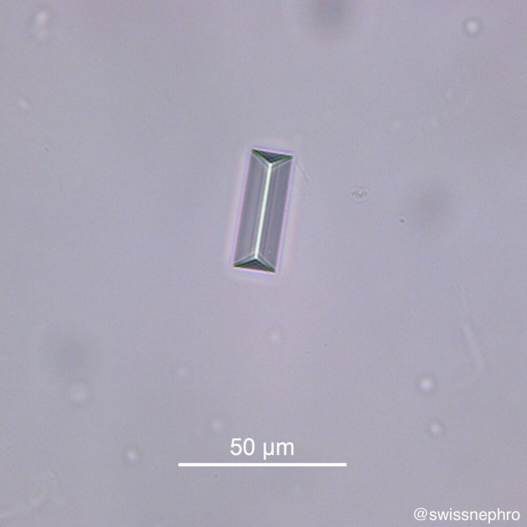 Urine Sediment of the Month: Common Crystals! - Renal Fellow Network