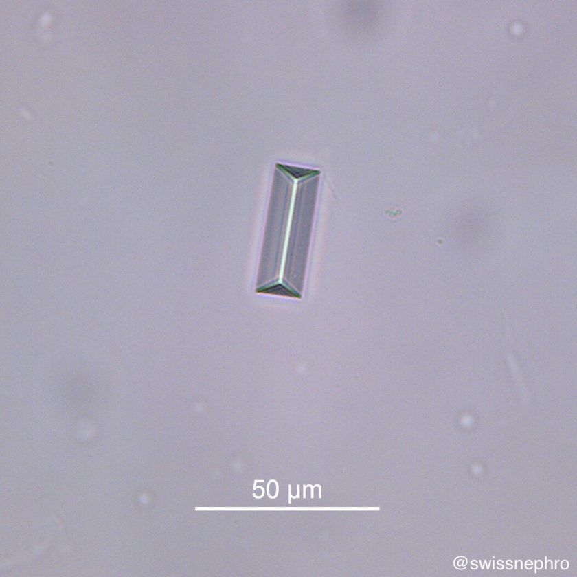 Urine Sediment of the Month: Common Crystals! - Renal Fellow Network