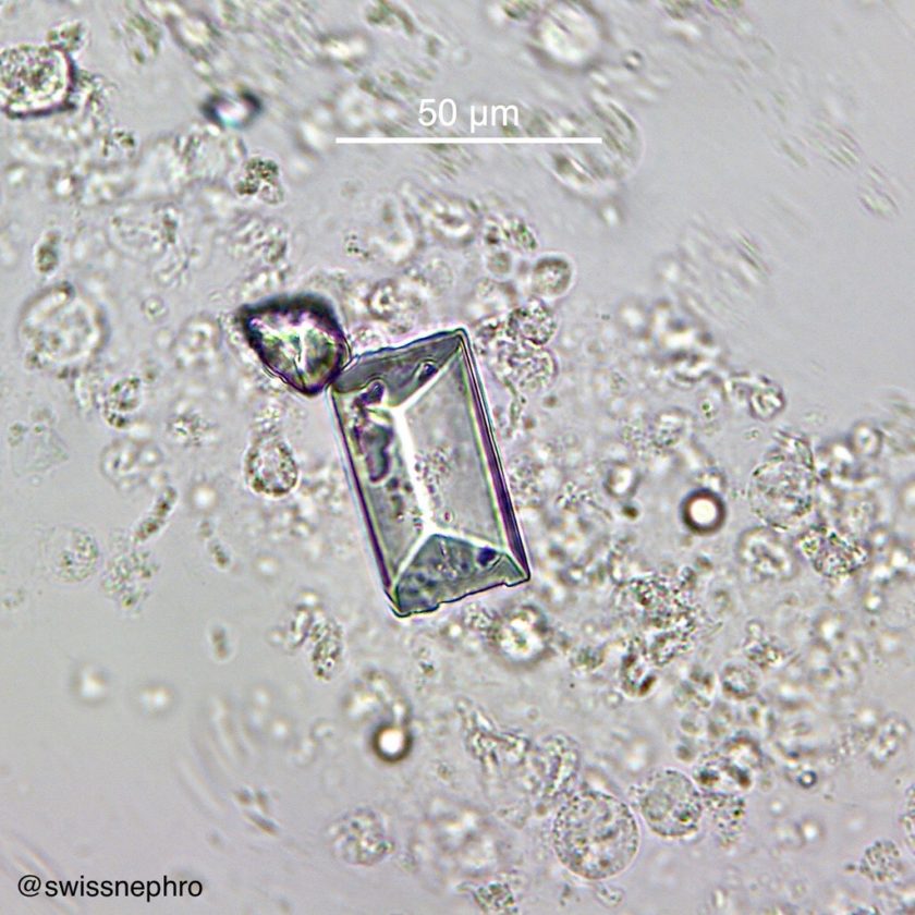 Urine Sediment of the Month: Common Crystals! - Renal Fellow Network