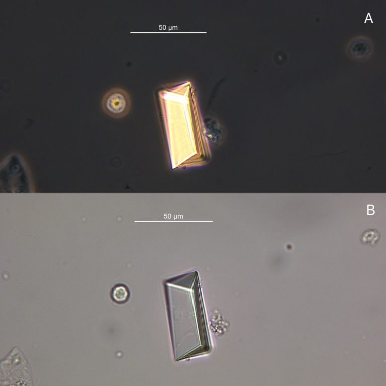 Urine Sediment of the Month: Common Crystals! - Renal Fellow Network