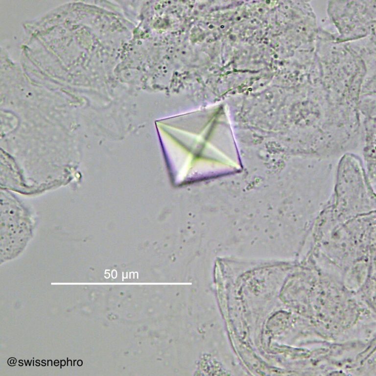 Urine Sediment of the Month: Common Crystals! - Renal Fellow Network
