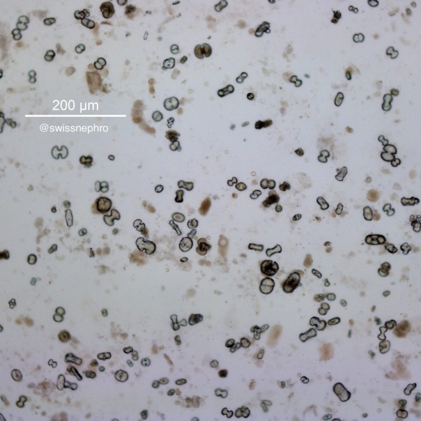 Urine Sediment of the Month: Common Crystals! - Renal Fellow Network