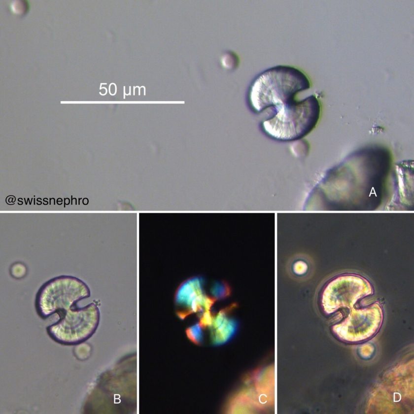Urine Sediment of the Month: Common Crystals! - Renal Fellow Network