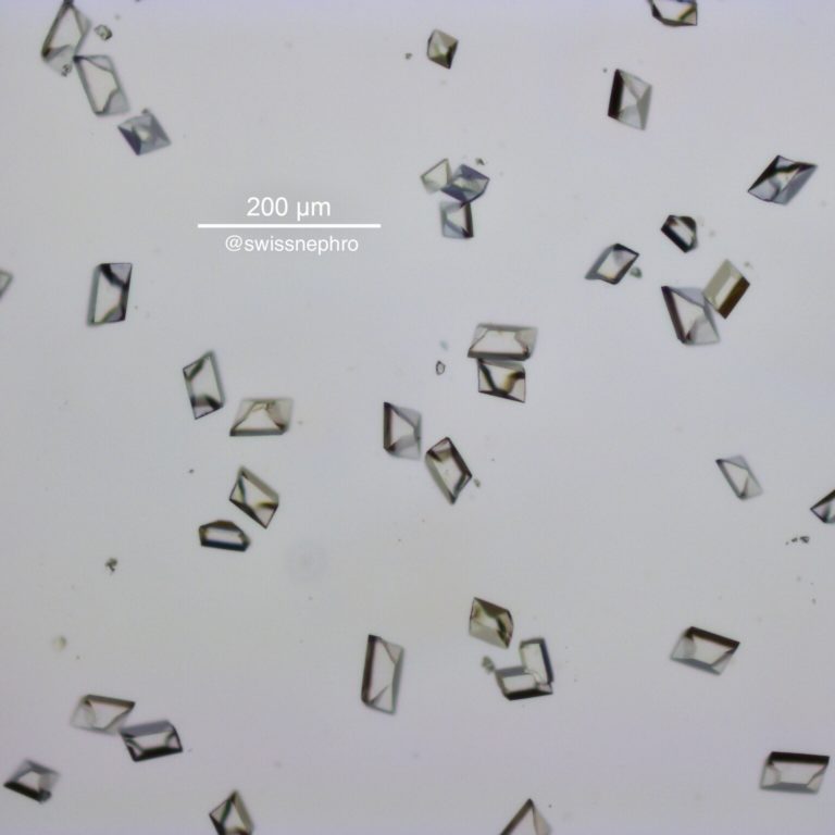Urine Sediment of the Month: Common Crystals! - Renal Fellow Network