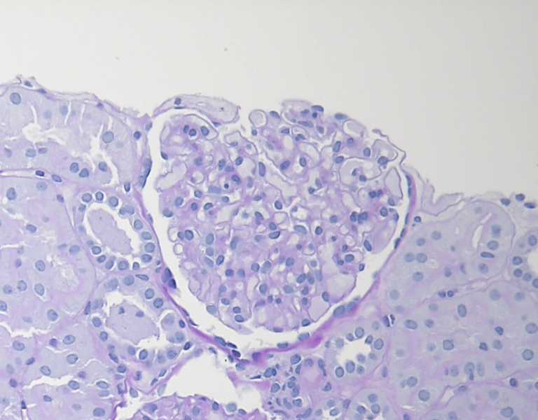 Kidney Biopsy of the Month: IgA Nephropathy - Renal Fellow Network