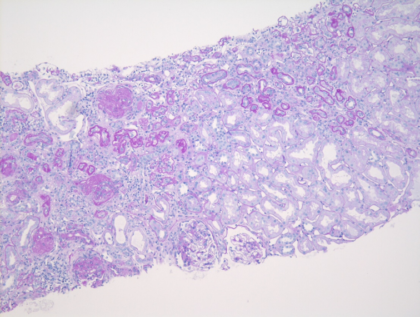 Kidney Biopsy of the Month: IgA Nephropathy - Renal Fellow Network