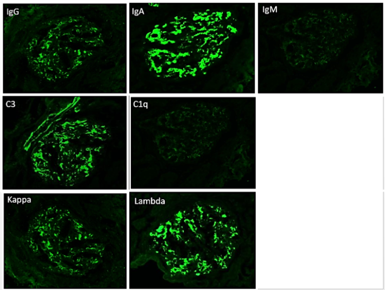 Kidney Biopsy of the Month: IgA Nephropathy - Renal Fellow Network