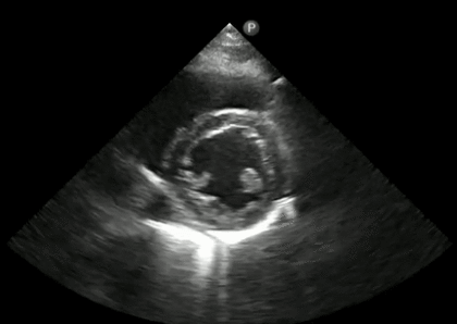 Pediatric Series: Kidney Echogenicity in Children: Clinical Correlation ...
