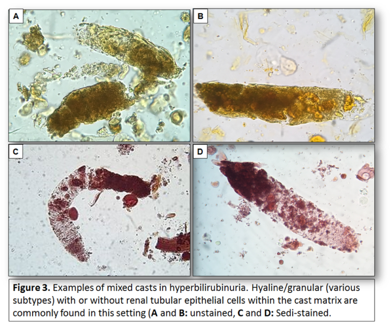 Urine Sediment of the Month: Mixed, Acellular Casts - Renal Fellow Network