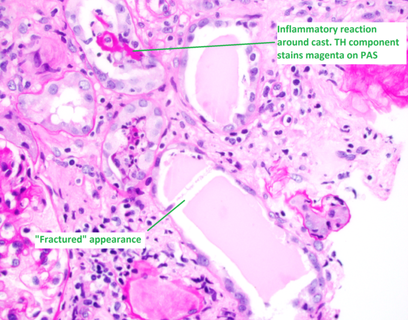 Kidney Biopsy of the Month: Light Chain Cast Nephropathy - Renal Fellow ...