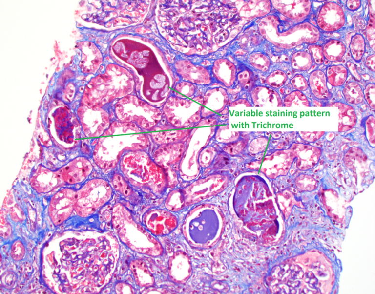 Kidney Biopsy of the Month: Light Chain Cast Nephropathy - Renal Fellow ...