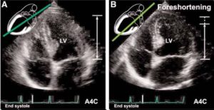 Focused Cardiac Ultrasound for the Nephrologist: The apical window ...
