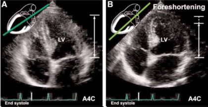 Focused Cardiac Ultrasound for the Nephrologist: The apical window ...