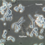 Urine Sediment of the Month: Microorganisms - Renal Fellow Network
